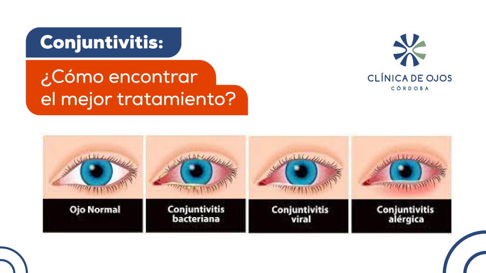 Conjuntivitis Síntomas y Tratamientos Clínica de Ojos Córdoba