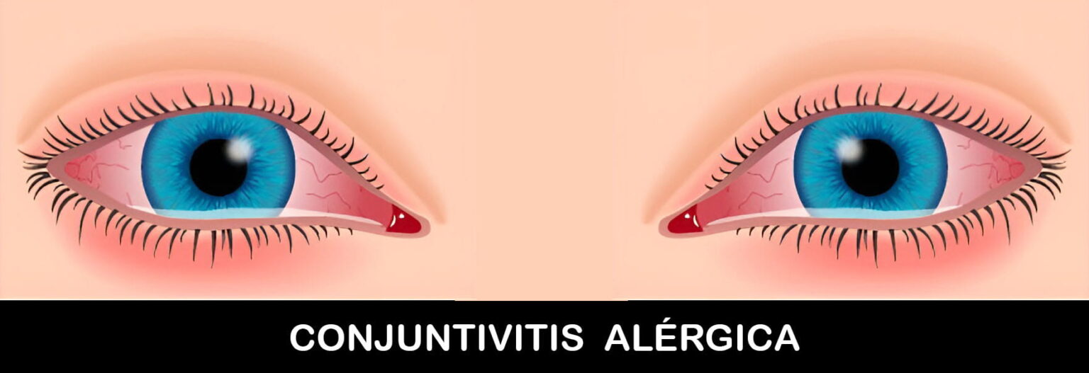 Conjuntivitis Síntomas y Tratamientos Clínica de Ojos Córdoba