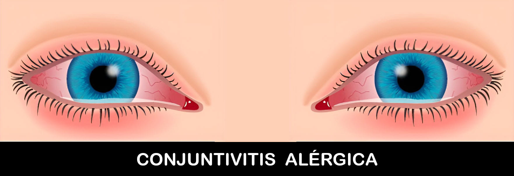 Conjuntivitis Síntomas y Tratamientos Clínica de Ojos Córdoba