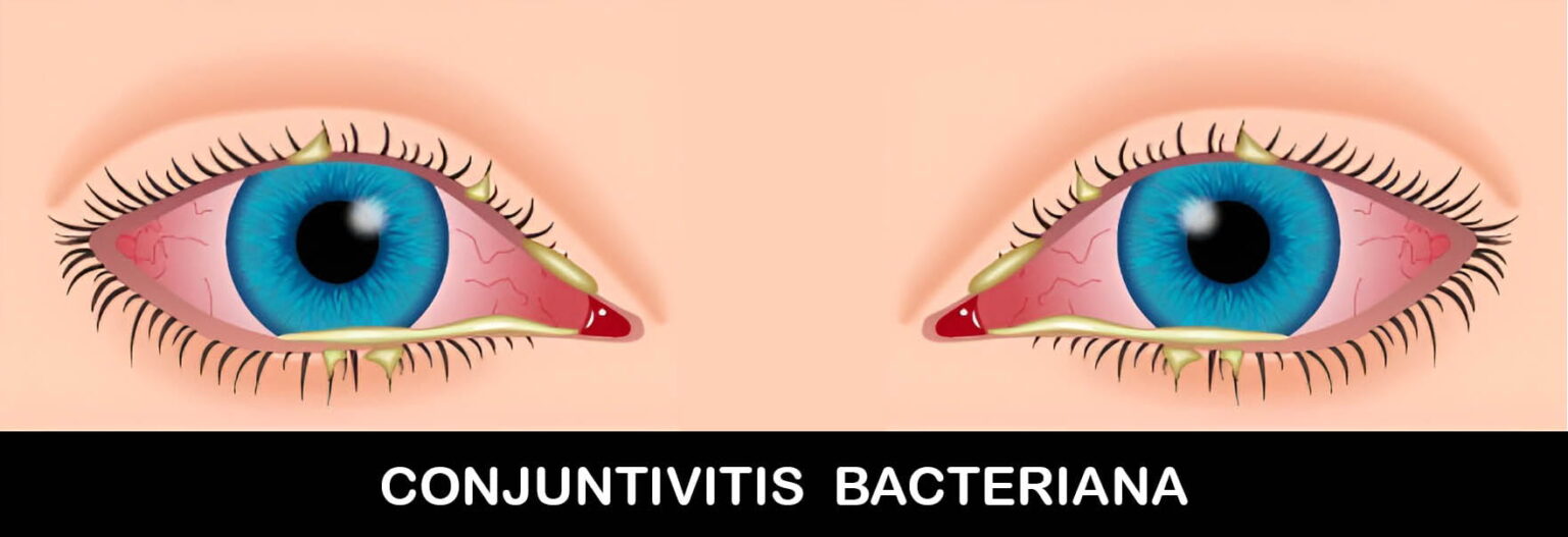 Conjuntivitis Síntomas y Tratamientos Clínica de Ojos Córdoba