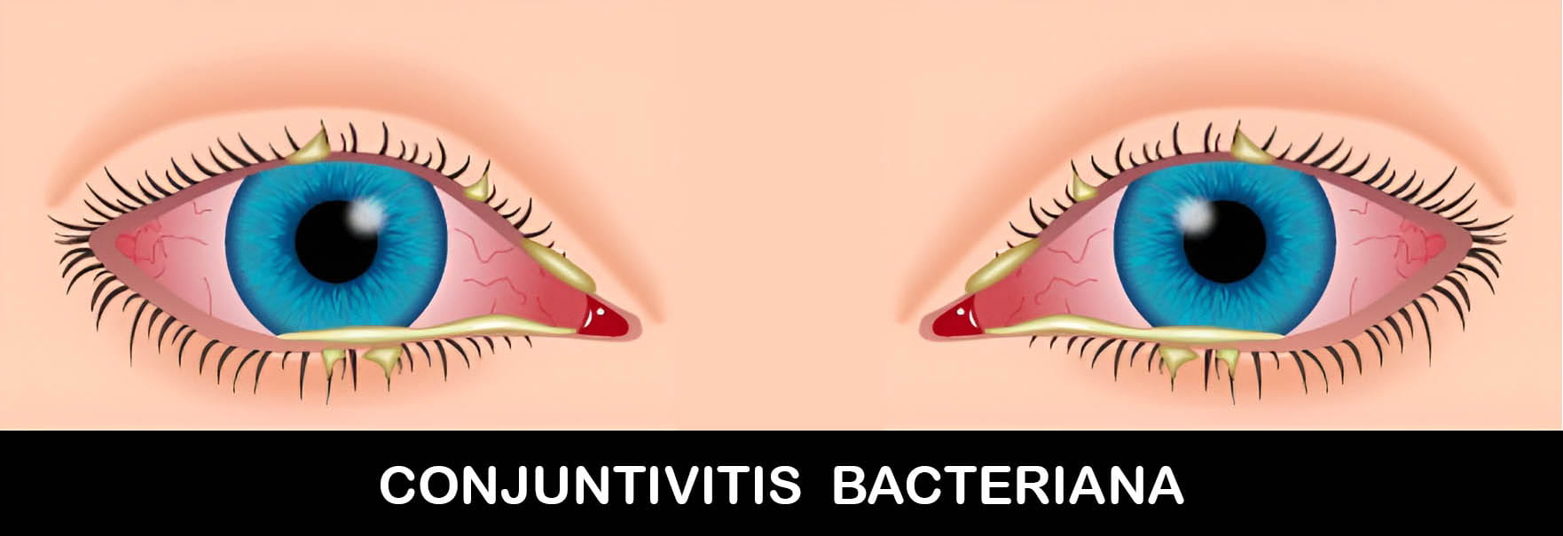 Conjuntivitis Síntomas y Tratamientos Clínica de Ojos Córdoba