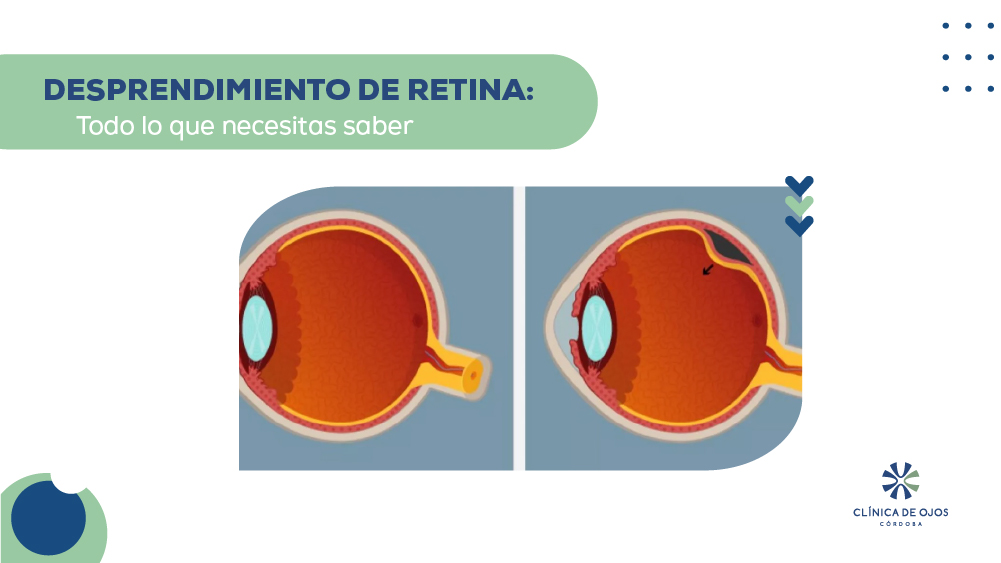 Desprendimiento de Retina: Causas, Síntomas y Tratamiento - Clínica de ...