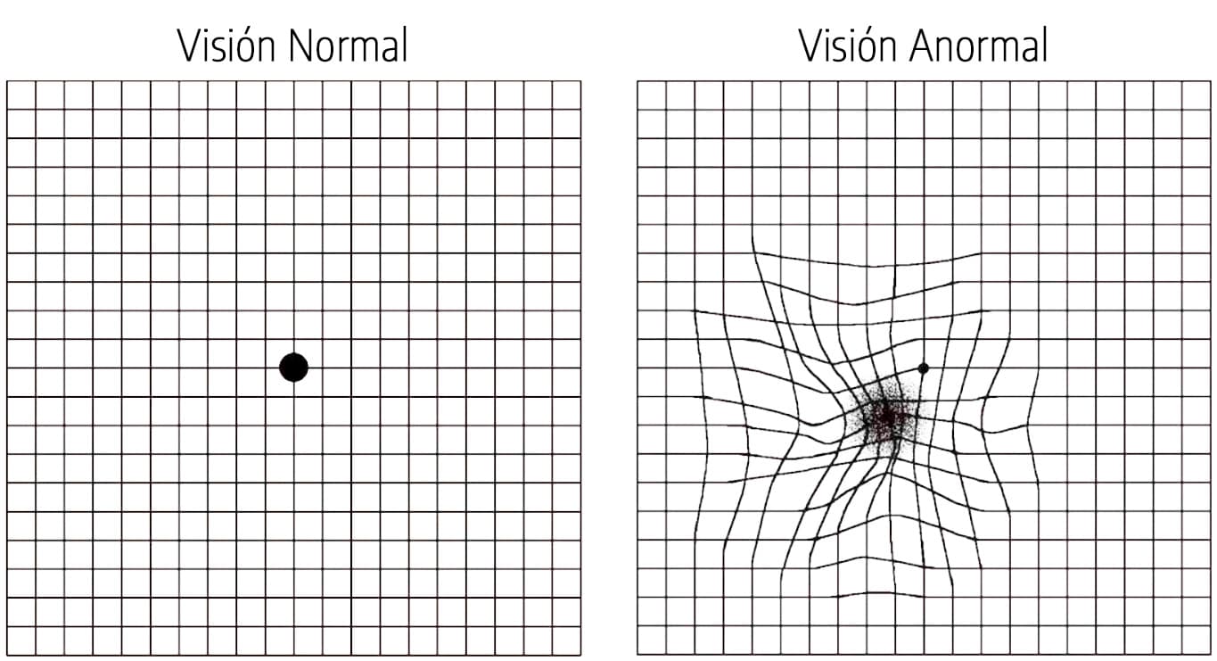 Degeneración Macular - Clínica de Ojos Córdoba