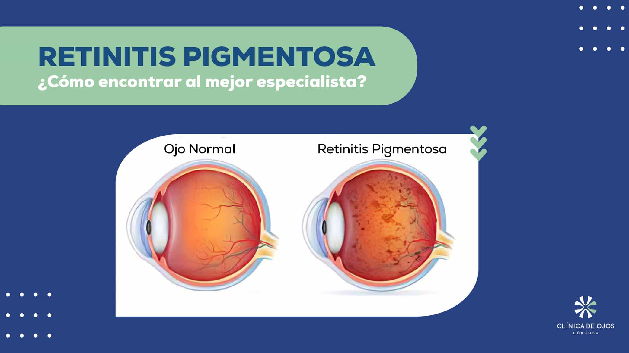Retinitis pigmentosa: ¿Cómo encontrar al mejor especialista? - Clínica ...