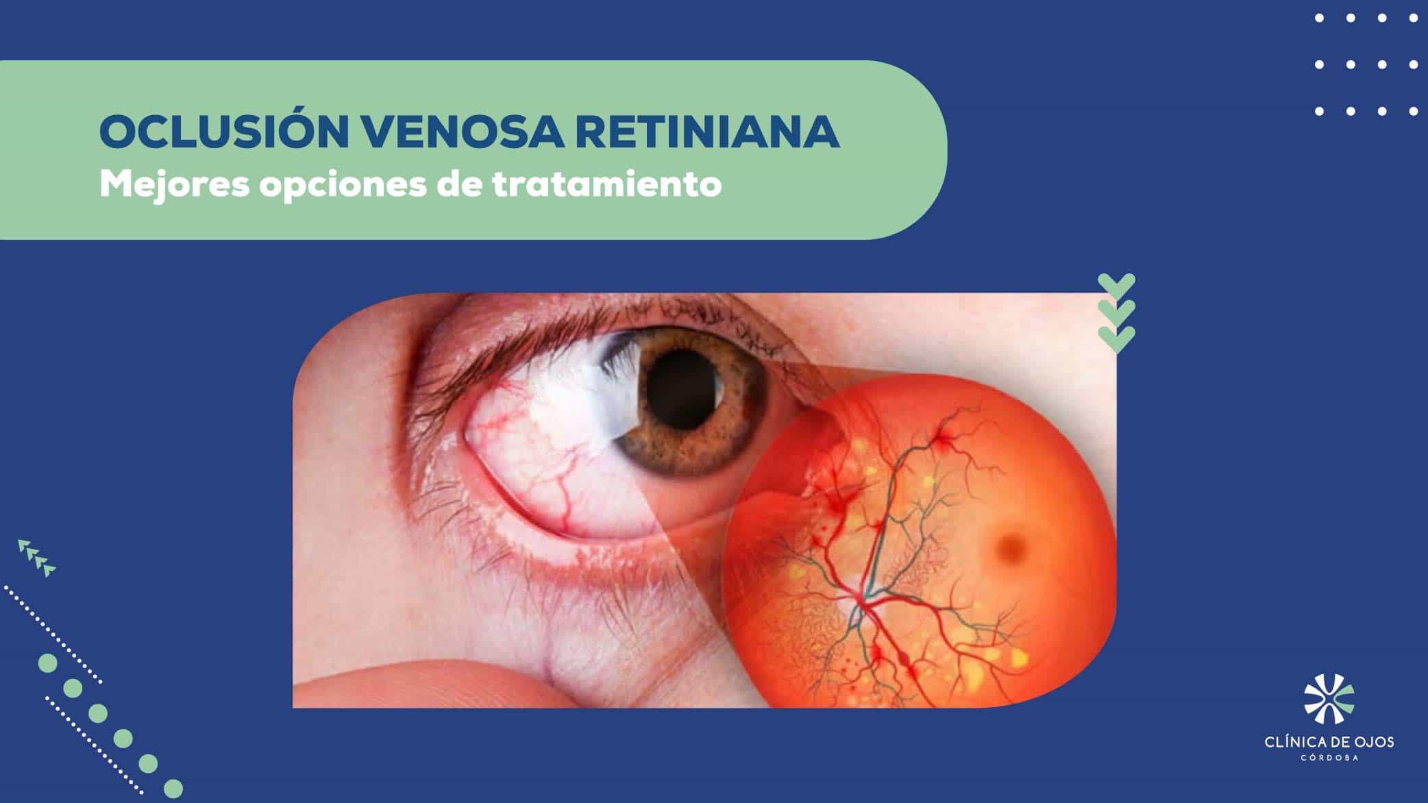 Anatomía De La Arteria Retiniana Obstrucción De La Arteria Central