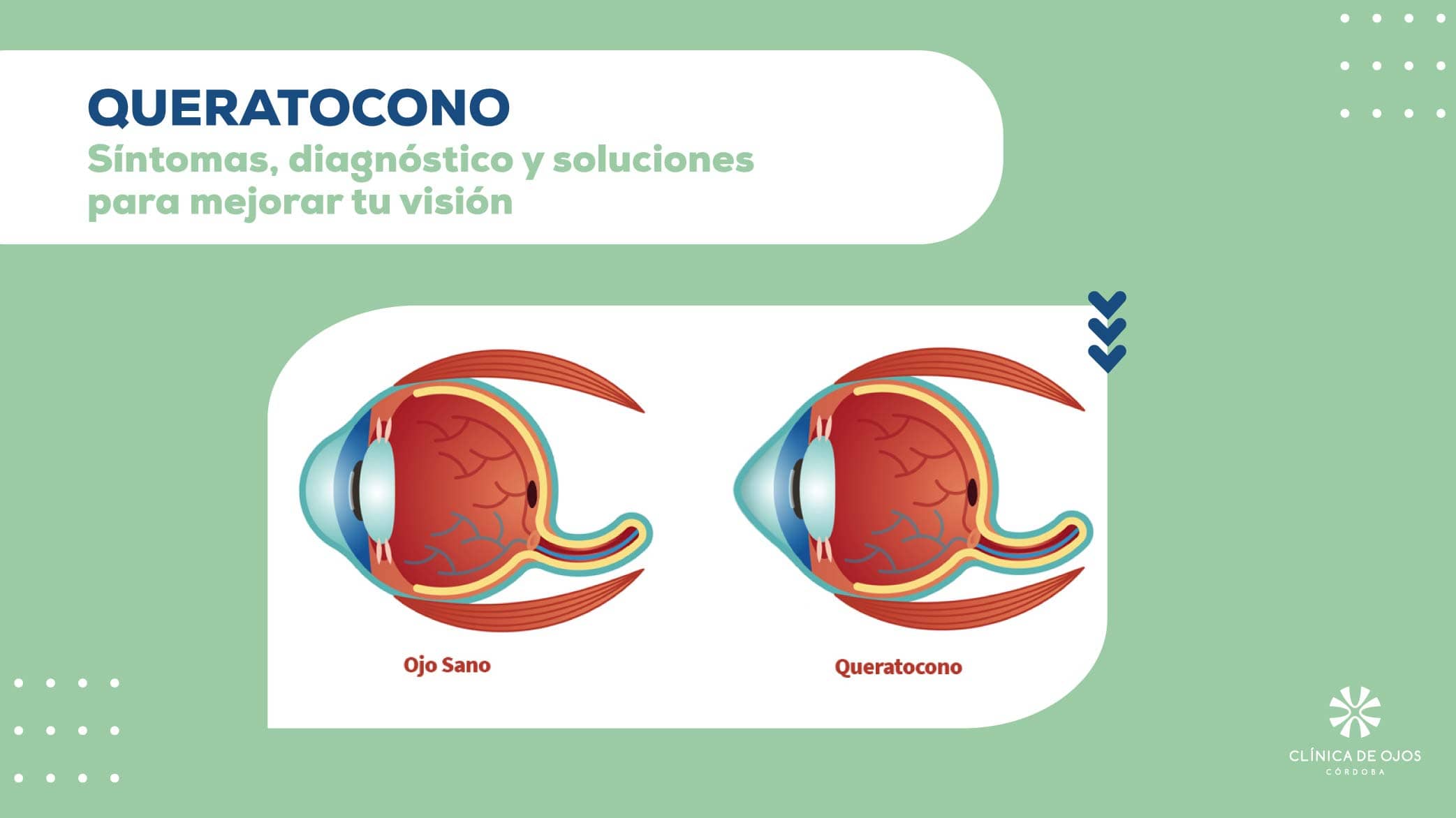 Queratocono Síntomas y Tratamiento - Clínica de Ojos Córdoba