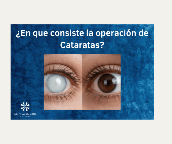 Operación de cataratas Procedimiento - Clínica de Ojos Córdoba