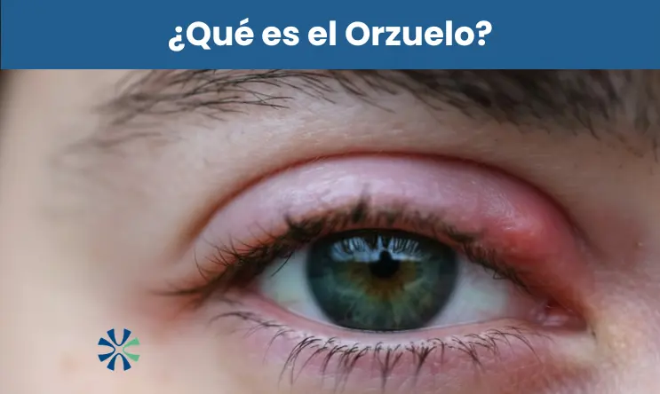 ¿Qué es el Orzuelo? - Clínica de Ojos Córdoba